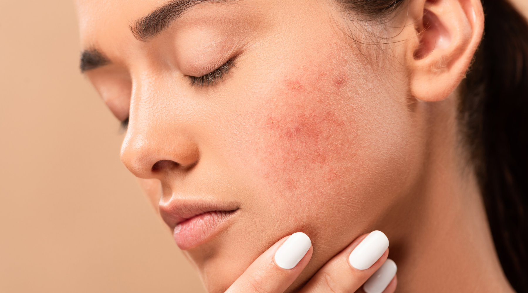 A Guide to Caring for Pimples & Breakout